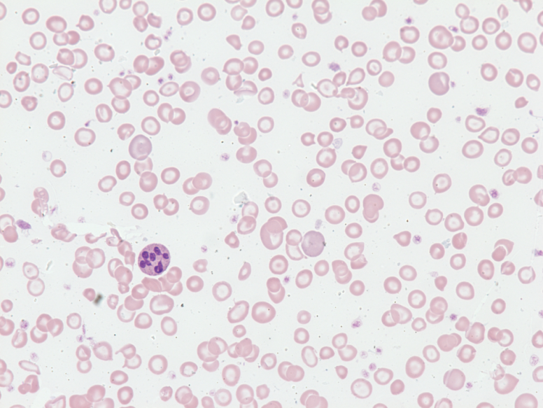 Iron Deficiency Anemia The Blood Project