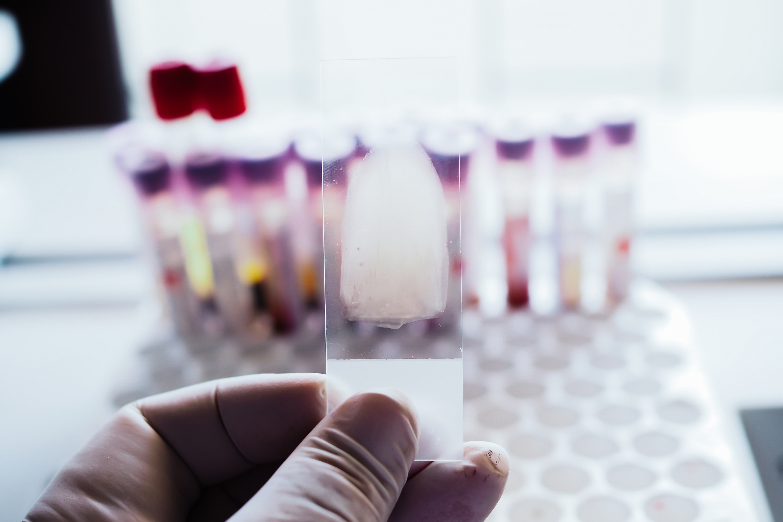 Iron Deficiency Anemia The Blood Project