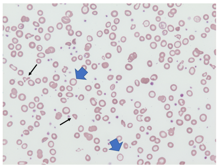 Iron Deficiency Anemia • The Blood Project