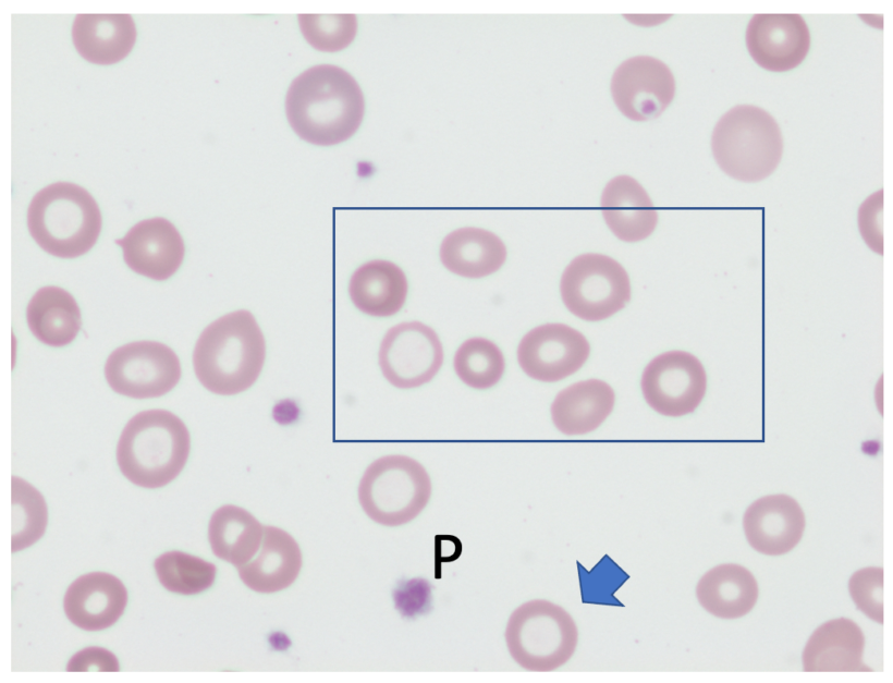 Iron Deficiency Anemia • The Blood Project