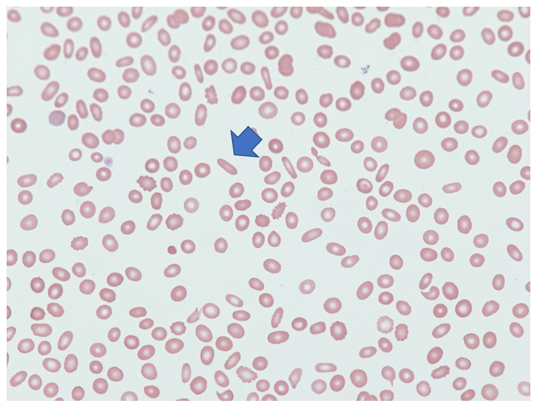 Iron Deficiency Anemia The Blood Project