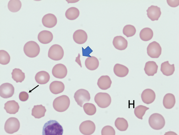 Case TTP • The Blood Project