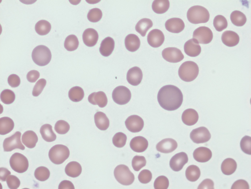 Spherocytes • The Blood Project