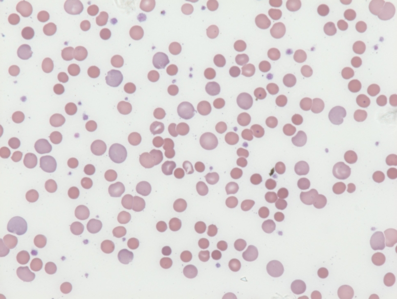 Spherocytes • The Blood Project