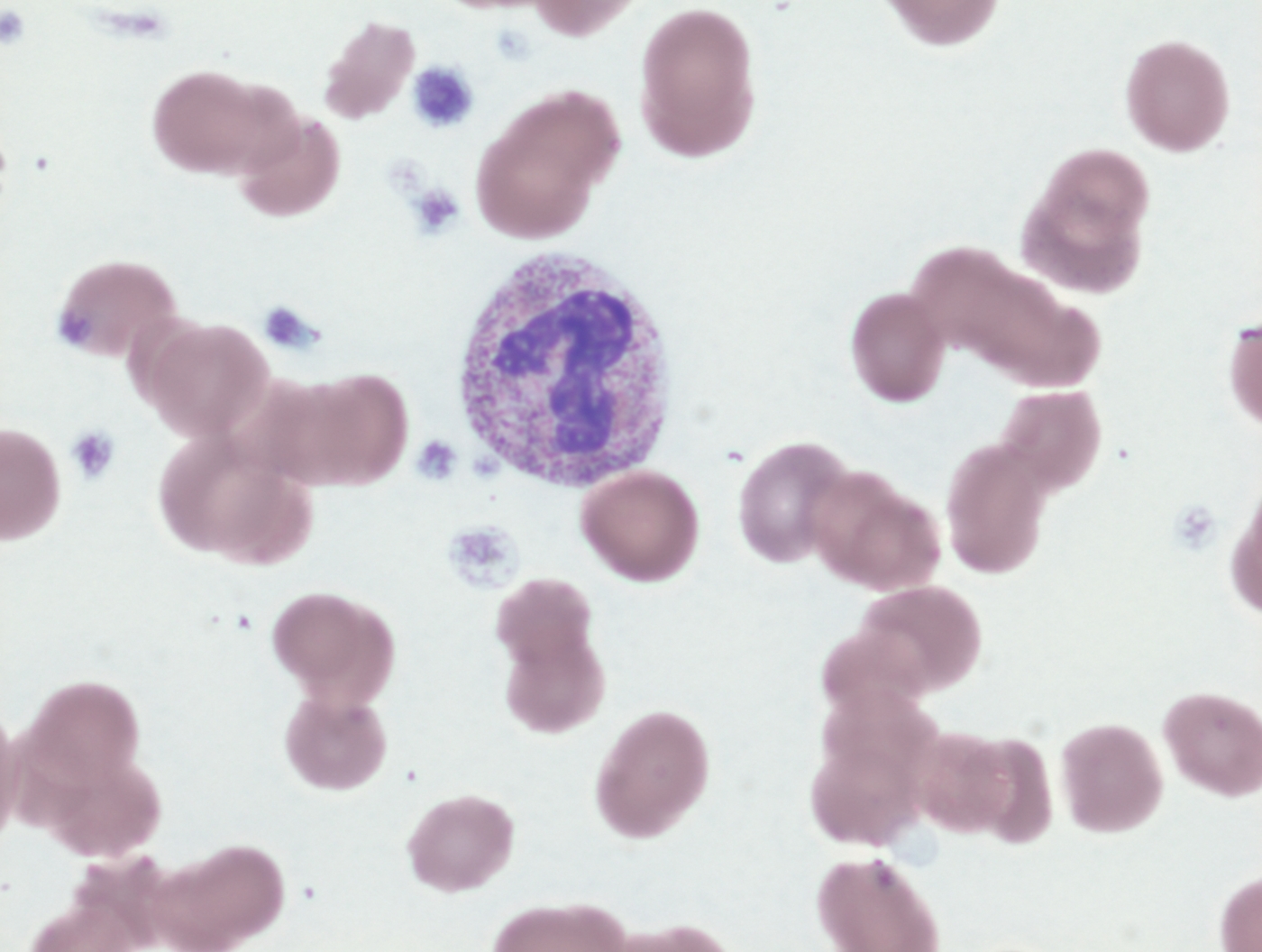 Promyelocytes • The Blood Project