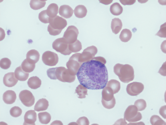 Promyelocytes • The Blood Project