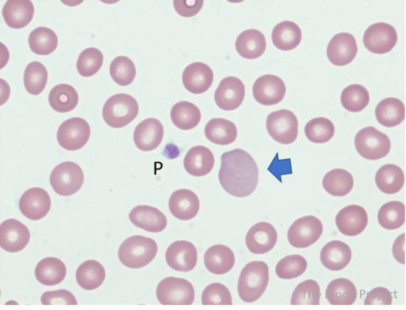 Polychromatophilic Cells • The Blood Project