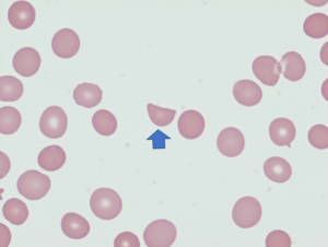 Helmet cells • The Blood Project