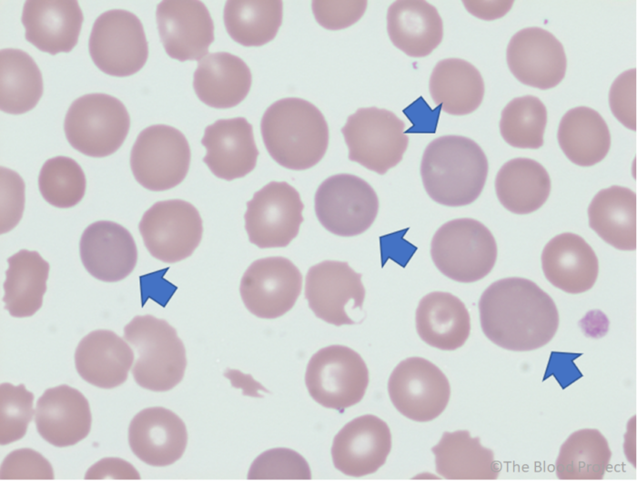 Polychromatophilic Cells • The Blood Project