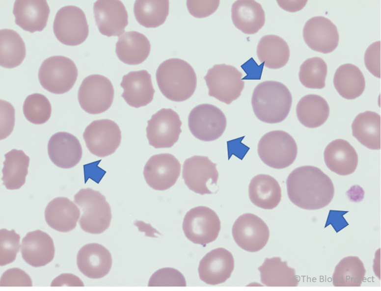 Polychromatophilic Cells • The Blood Project