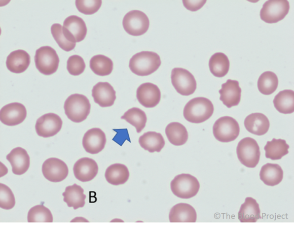 Keratocytes (Horn Cells) • The Blood Project