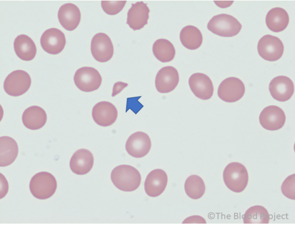 Triangular cells • The Blood Project