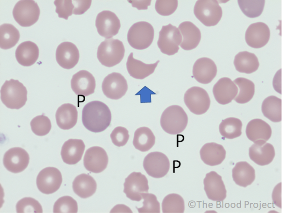 Keratocytes (Horn Cells) • The Blood Project