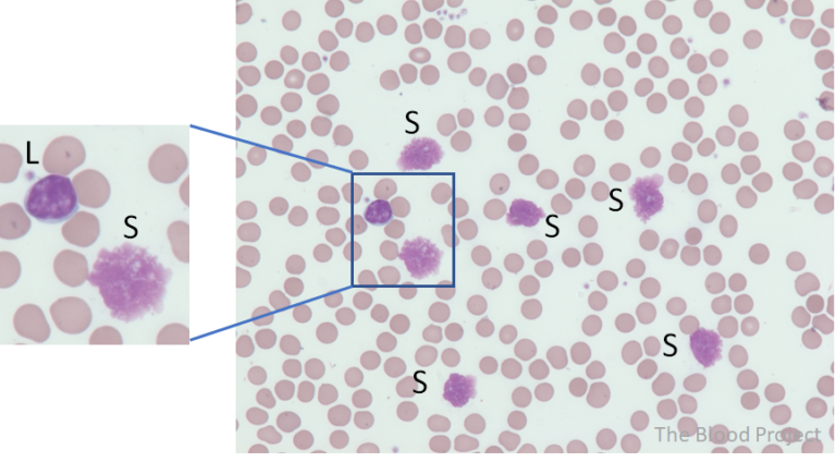 Smudge Cells • The Blood Project