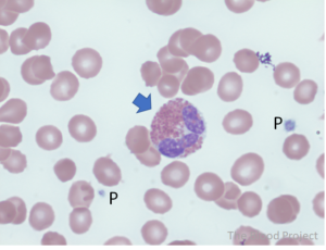 Eosinophils • The Blood Project