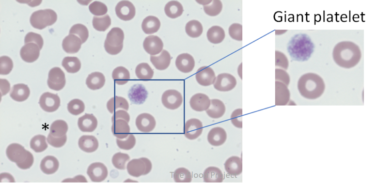 Giant Platelets • The Blood Project