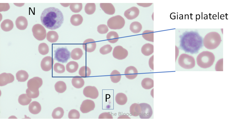 Giant Platelets • The Blood Project