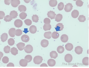 Babesia • The Blood Project