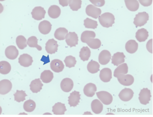 Babesia • The Blood Project