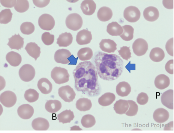 Neutrophil Vacuoles • The Blood Project