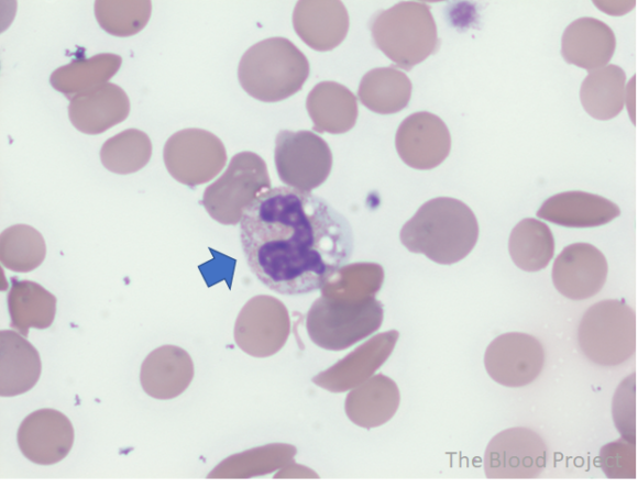 Neutrophil Vacuoles • The Blood Project