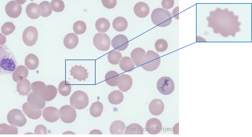 Echinocytes (Burr Cells) • The Blood Project