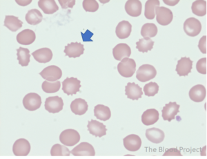 Echinocytes (Burr Cells) • The Blood Project