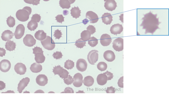 Acanthocytes (Spur Cells) • The Blood Project