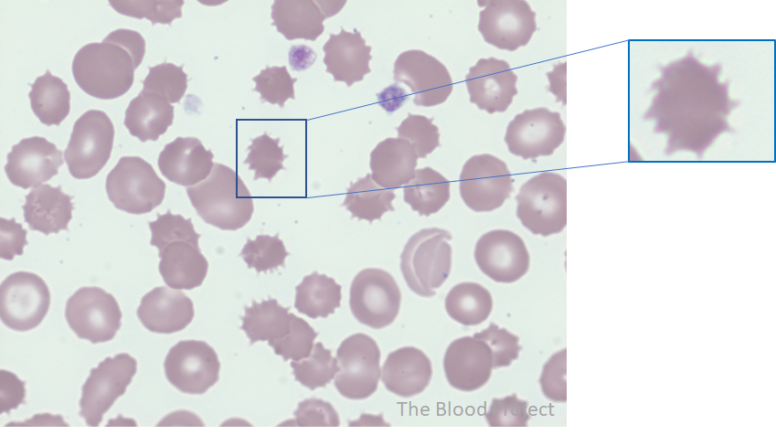 Acanthocytes (Spur Cells) • The Blood Project