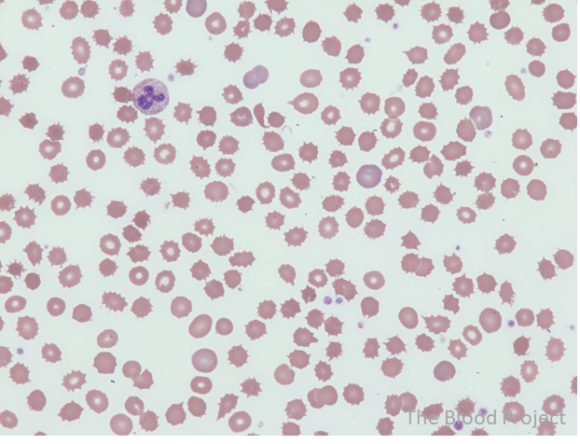 Acanthocytes (Spur Cells) • The Blood Project