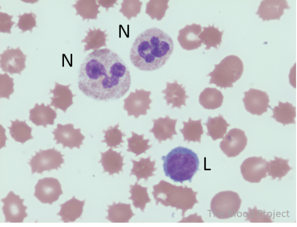 Acanthocytes (Spur Cells) • The Blood Project