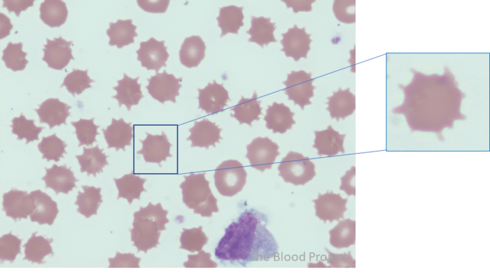 Acanthocytes (Spur Cells) • The Blood Project