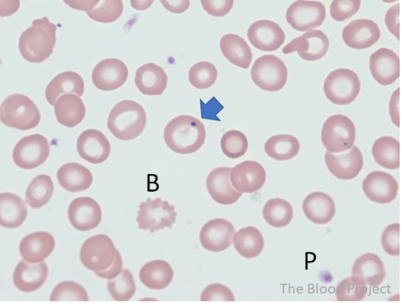 Howell-Jolly Bodies • The Blood Project