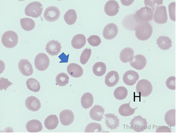 Howell-Jolly Bodies • The Blood Project