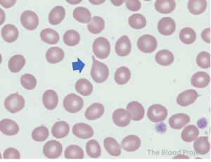 Teardrop Cells • The Blood Project