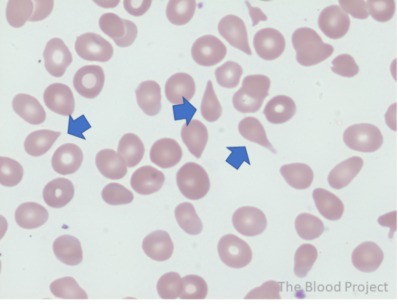 Teardrop Cells • The Blood Project