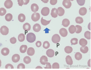 Schistocytes • The Blood Project