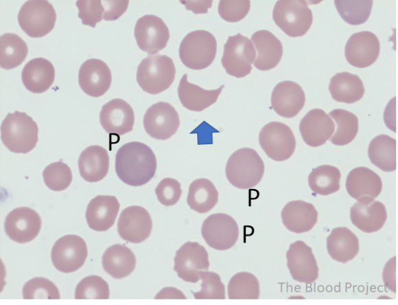Schistocytes • The Blood Project