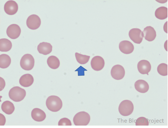 Schistocytes • The Blood Project