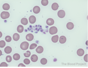 Platelet Clumping • The Blood Project