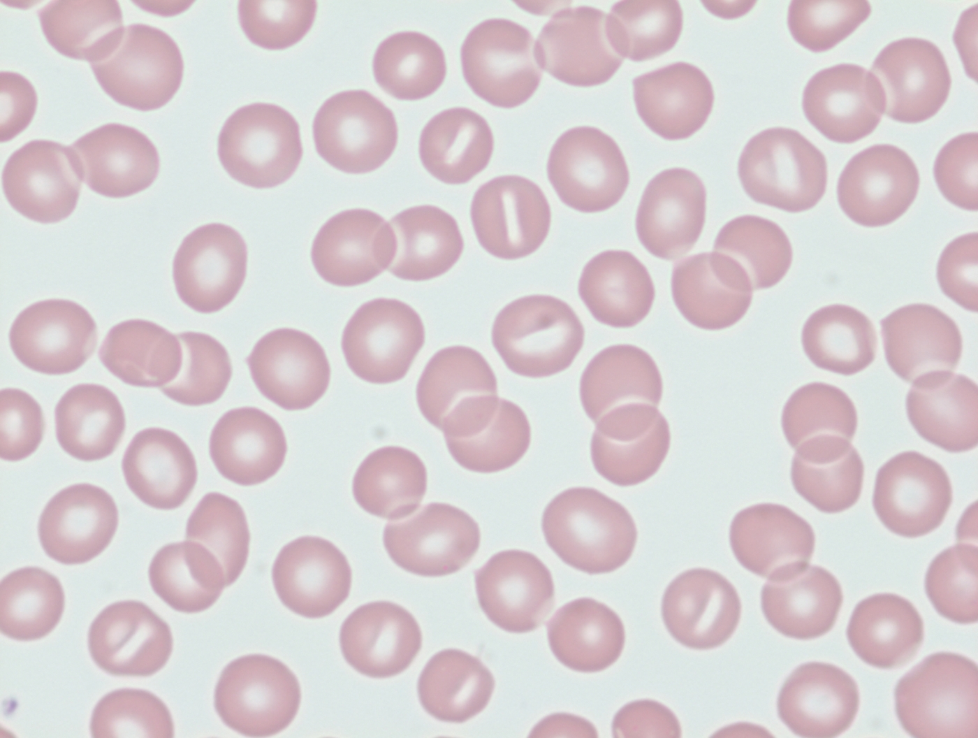 Stomatocytes • The Blood Project