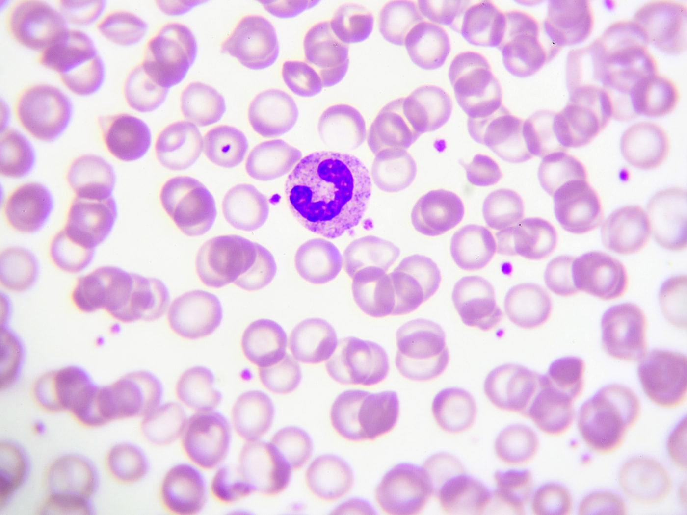 What is a band neutrophil? • The Blood Project