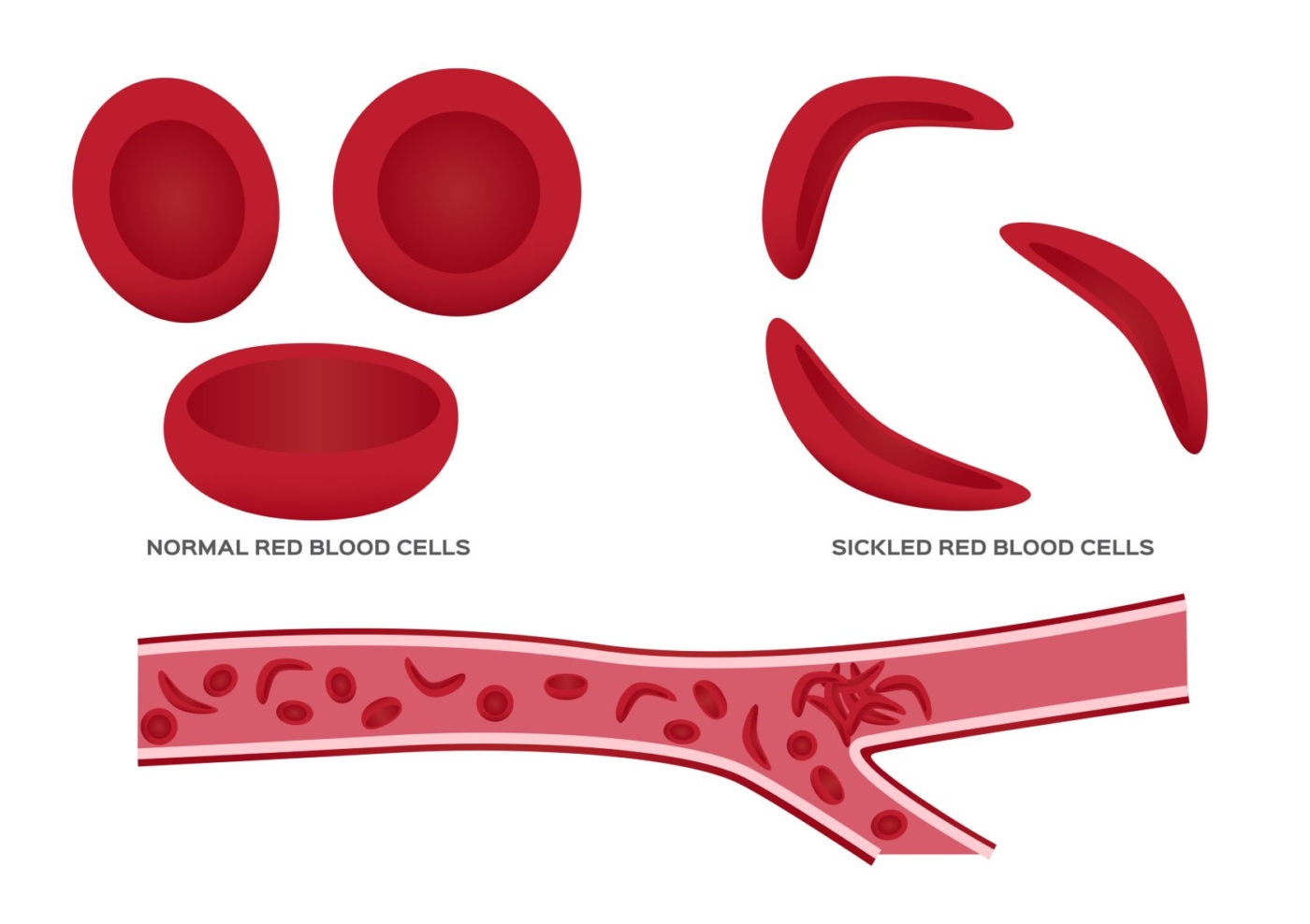 What causes vaso-occlusive crisis in sickle cell disease (SCD)? • The ...