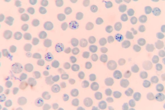 What is the difference between polychromatophilic red cell and a ...