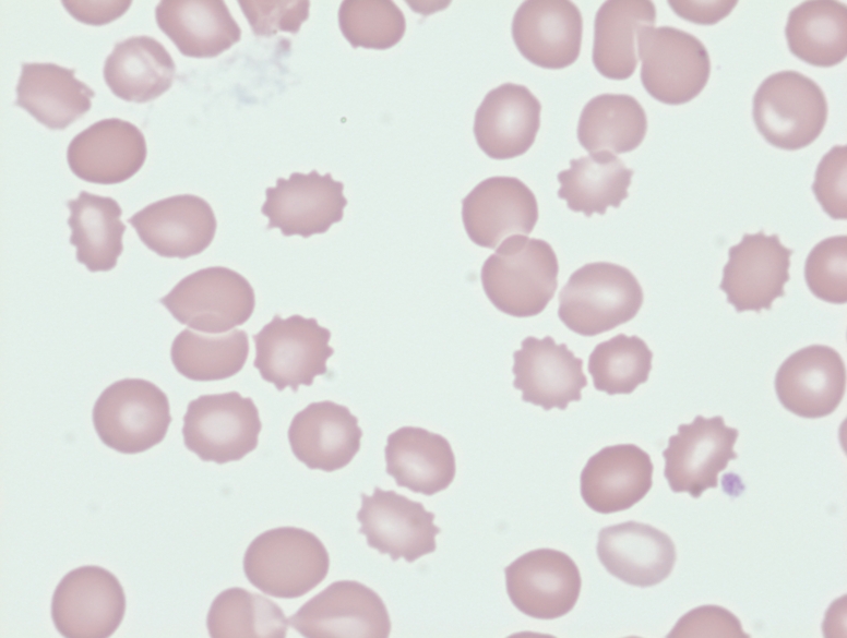 What is a burr cell? • The Blood Project