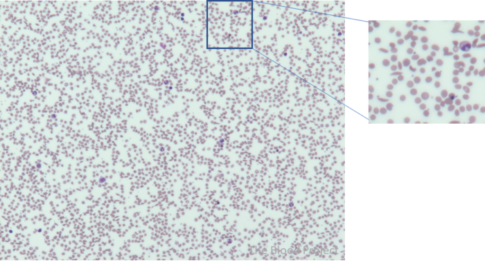 Sickle Cells • The Blood Project