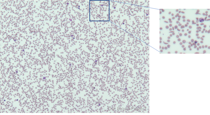 Sickle Cells • The Blood Project