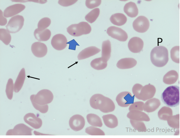 Sickle Cells • The Blood Project