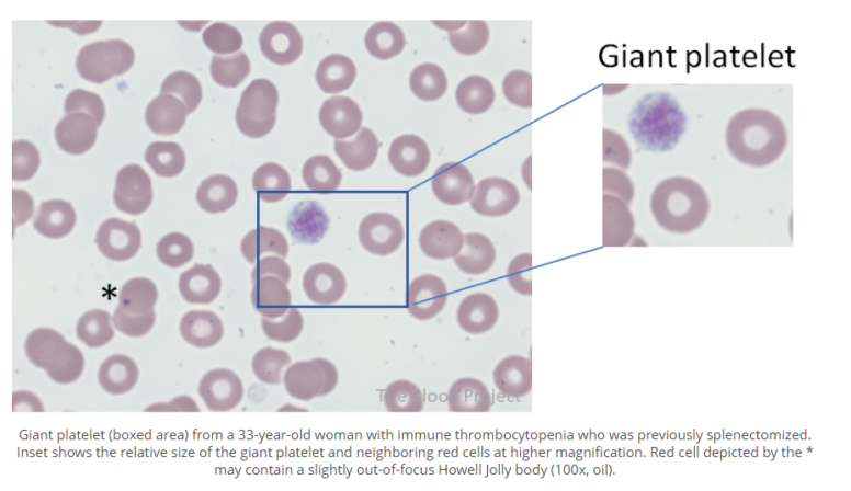 What is a giant platelet? • The Blood Project