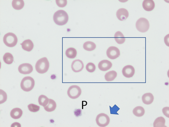 Iron Deficiency Anemia • The Blood Project